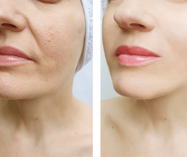 Thermage in a Nutshell - Gilbert Perfect Skin